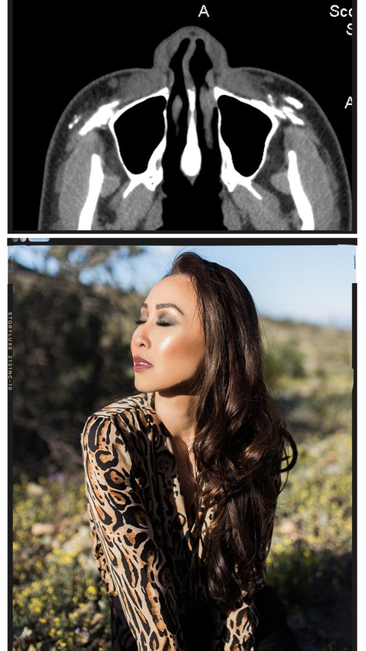 SEPTOPLASTY Recovery Day by Day: Deviated Septum Surgery + Recovery ...